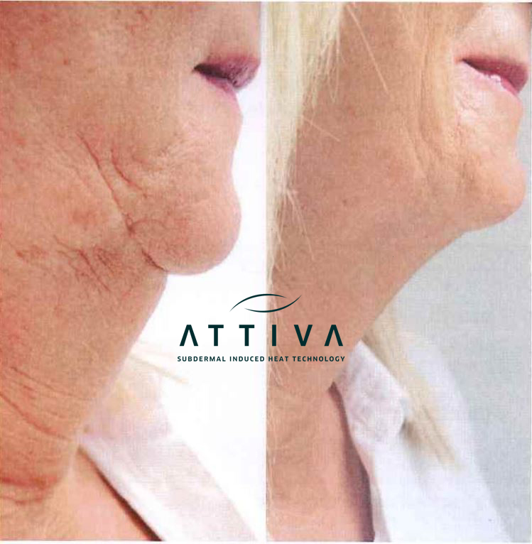Product Details - PharoDerma aesthetic products for health care